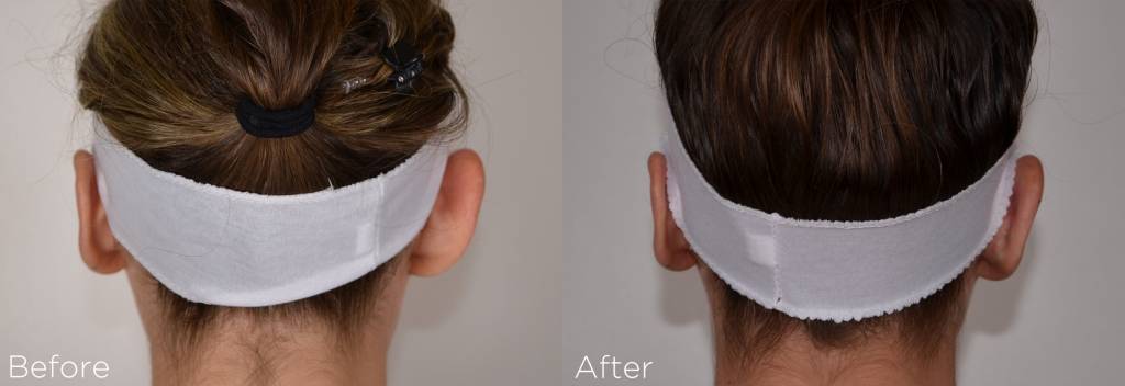 Case Study: Cosmetic Ear Surgery - Westlake Dermatology