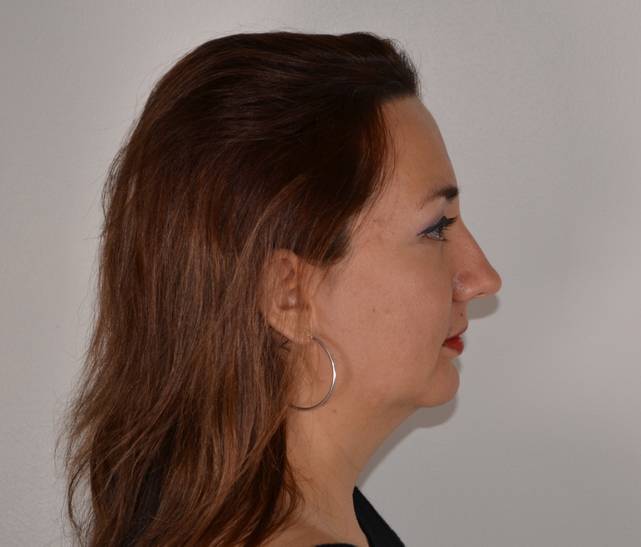 Chin Implant Surgery - Austin Chin Augmentation Specialists