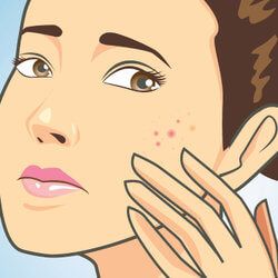 Should You Pop That Pimple? - Westlake Dermatology