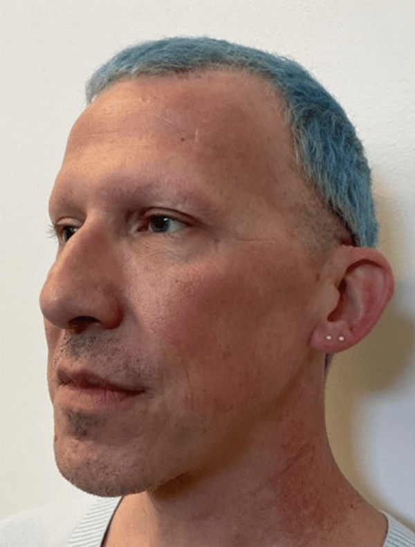 The #1 Sculptra Provider in Austin - Westlake Dermatololgy