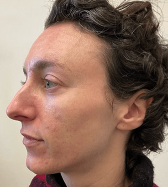 Accure Acne Laser Treatment - Advanced Light-Based Acne Treatments